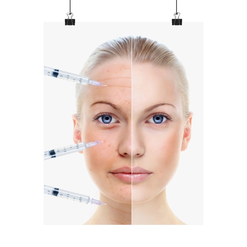 Botox Treatment Before and After Matte Vertical Poster, Medspa Nurse ...