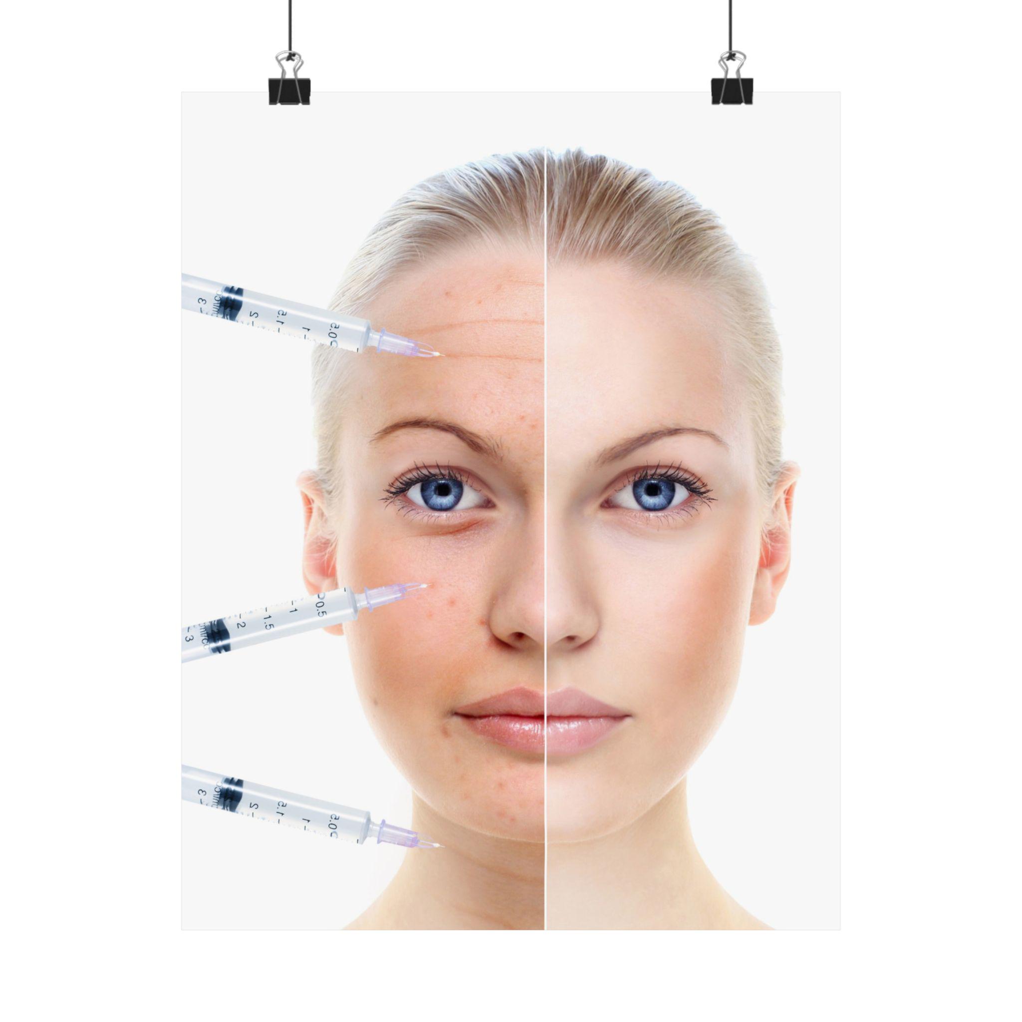 Botox Treatment Before and After Matte Vertical Poster, Medspa Nurse ...