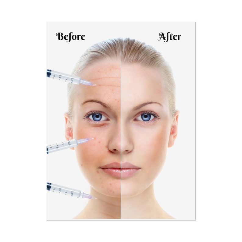Customized With Logo Botox Treatment Before and After Rolled Poster ...