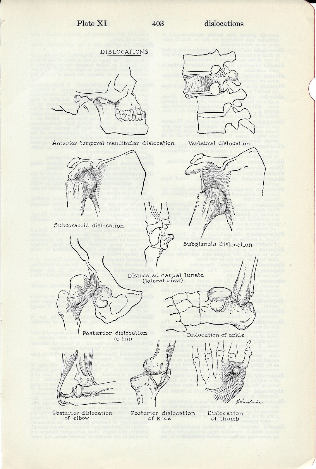 Human Anatomy Dislocation Types - Vintage Medical Anatomy Illustration ...