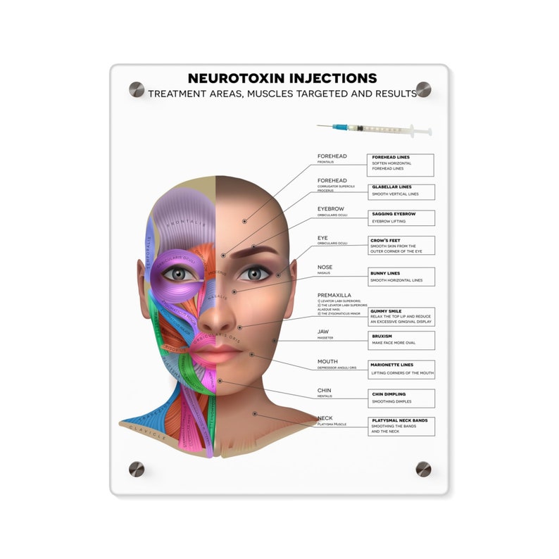 Neurotoxin Injections Placement Areas Acrylic Wall Art Panel, Nurse ...