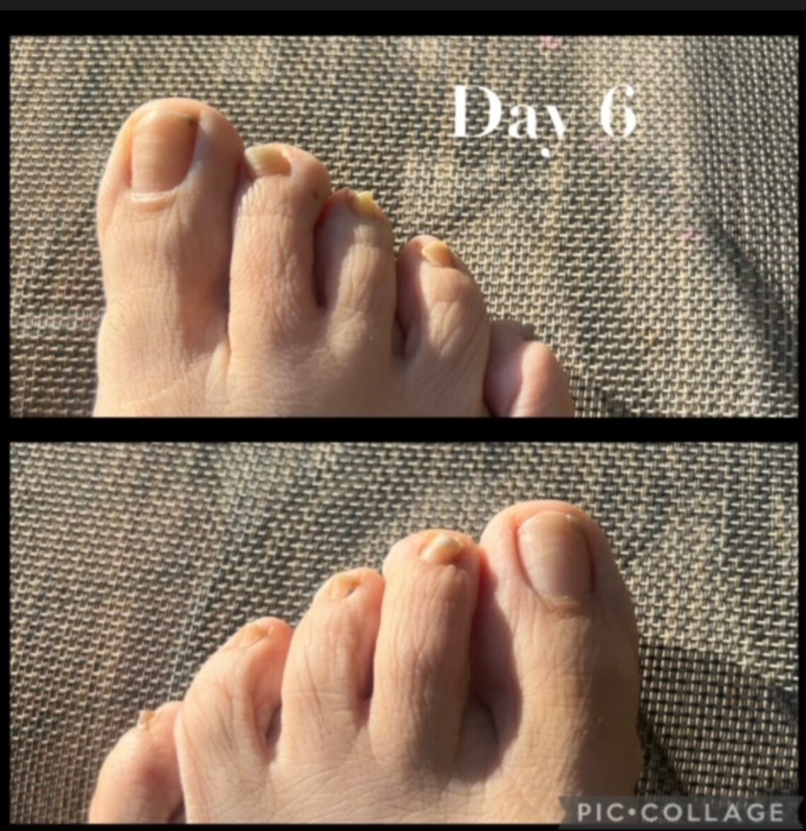 Toe Foot Fungus Natural Spray - Etsy