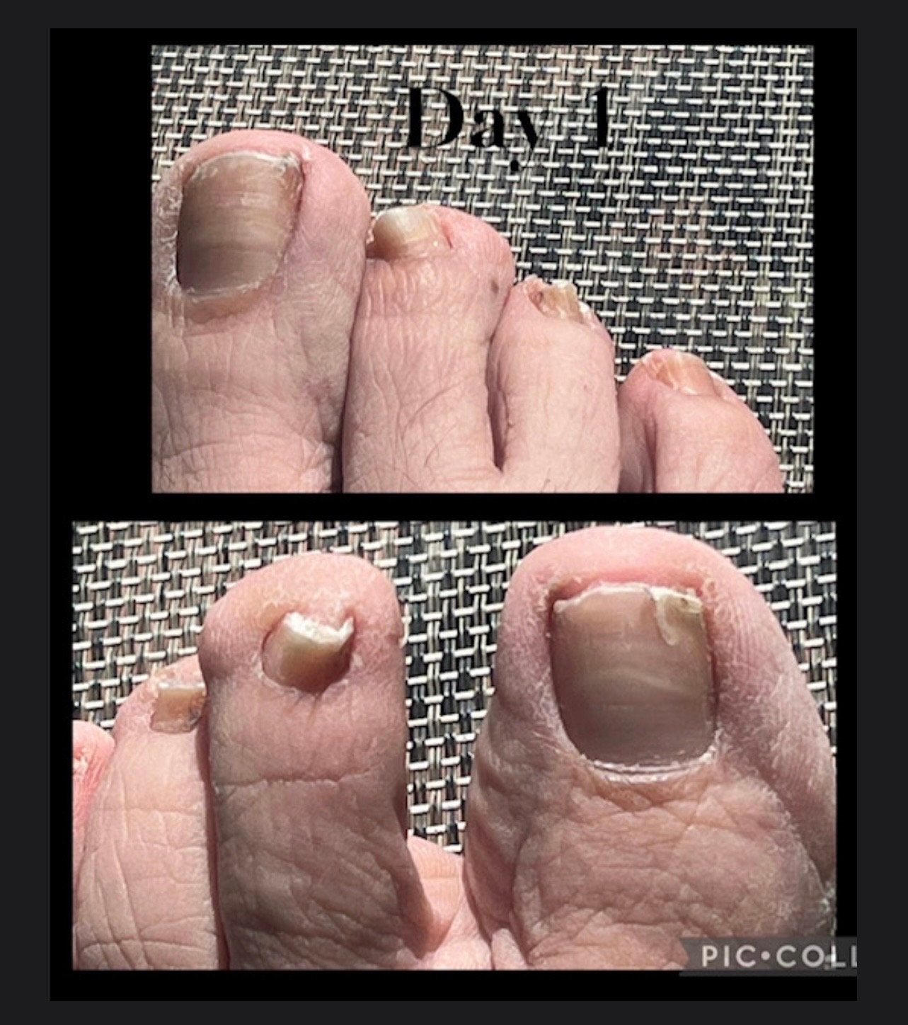 Toe Foot Fungus Natural Spray - Etsy