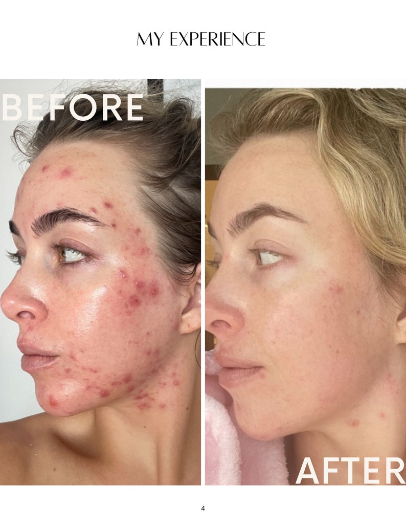 The Ultimate Acne Guide - Etsy