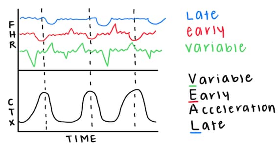 Fhr Accelerations With Contractions