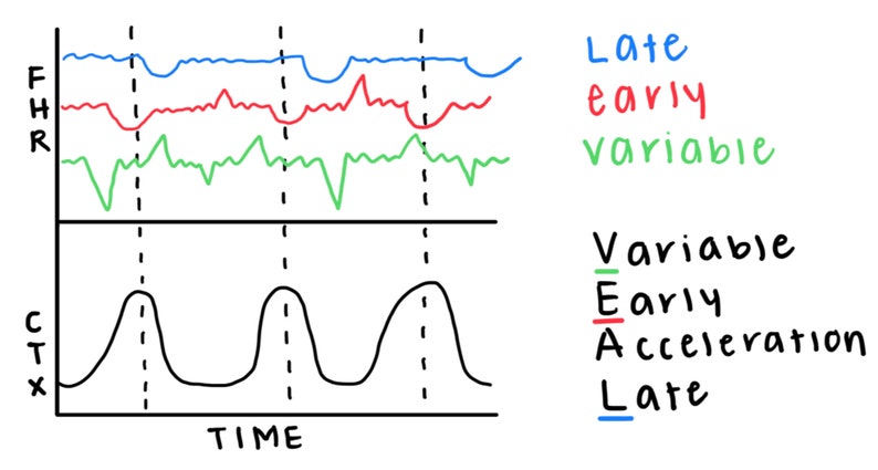 Labor and Delivery Fetal Heart Rate Interpretation Notes, OB Nursing ...