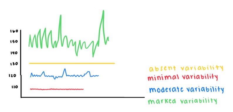 Labor and Delivery Fetal Heart Rate Interpretation Notes, OB Nursing ...
