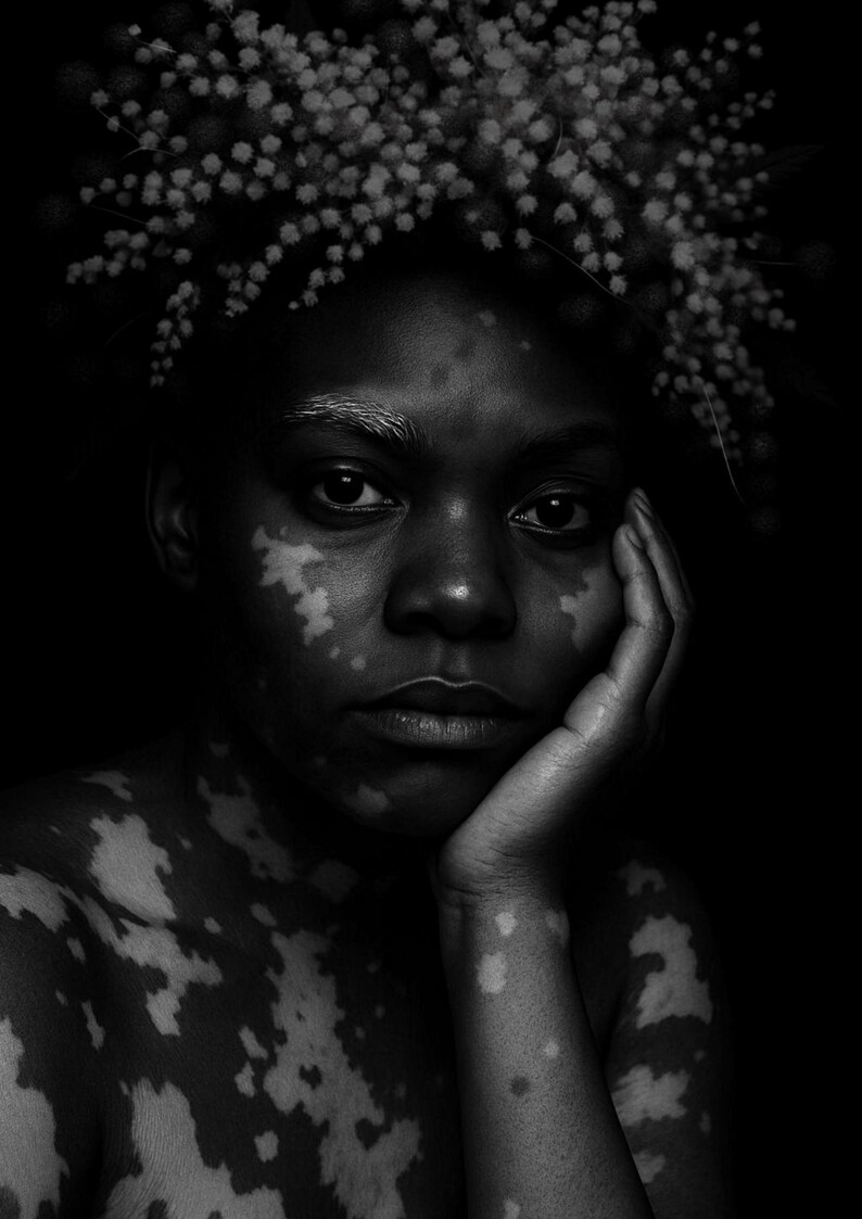 Vitiligo Beauty Portrait: Black Woman With Flowers (digital Download ...