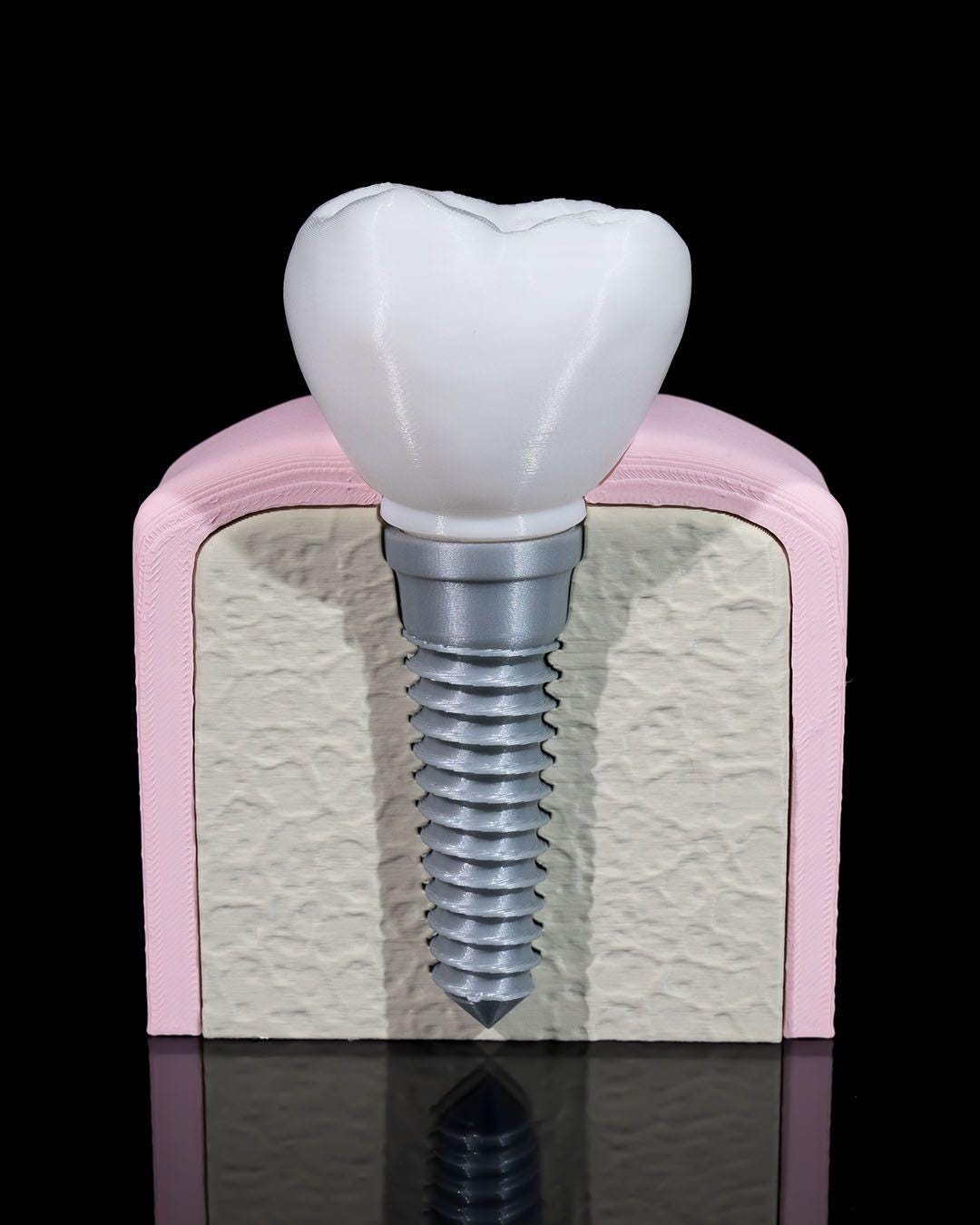 3D Printed Dental Implant Model – A Comprehensive Tool for ...