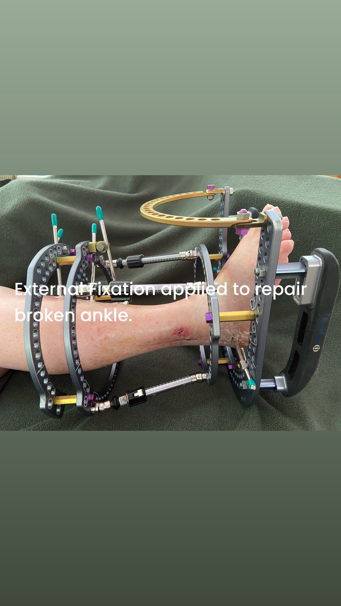 External Fixation Cover Wrap - Etsy