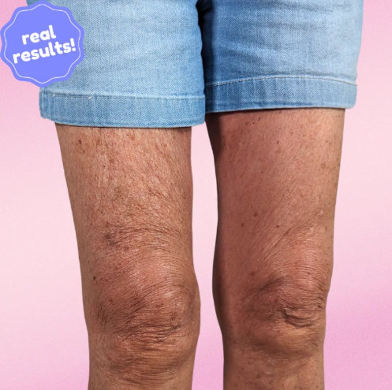 10 PACK: Tonee Skin-lifting Tape - Instant Cellulite Reduction, Skin ...