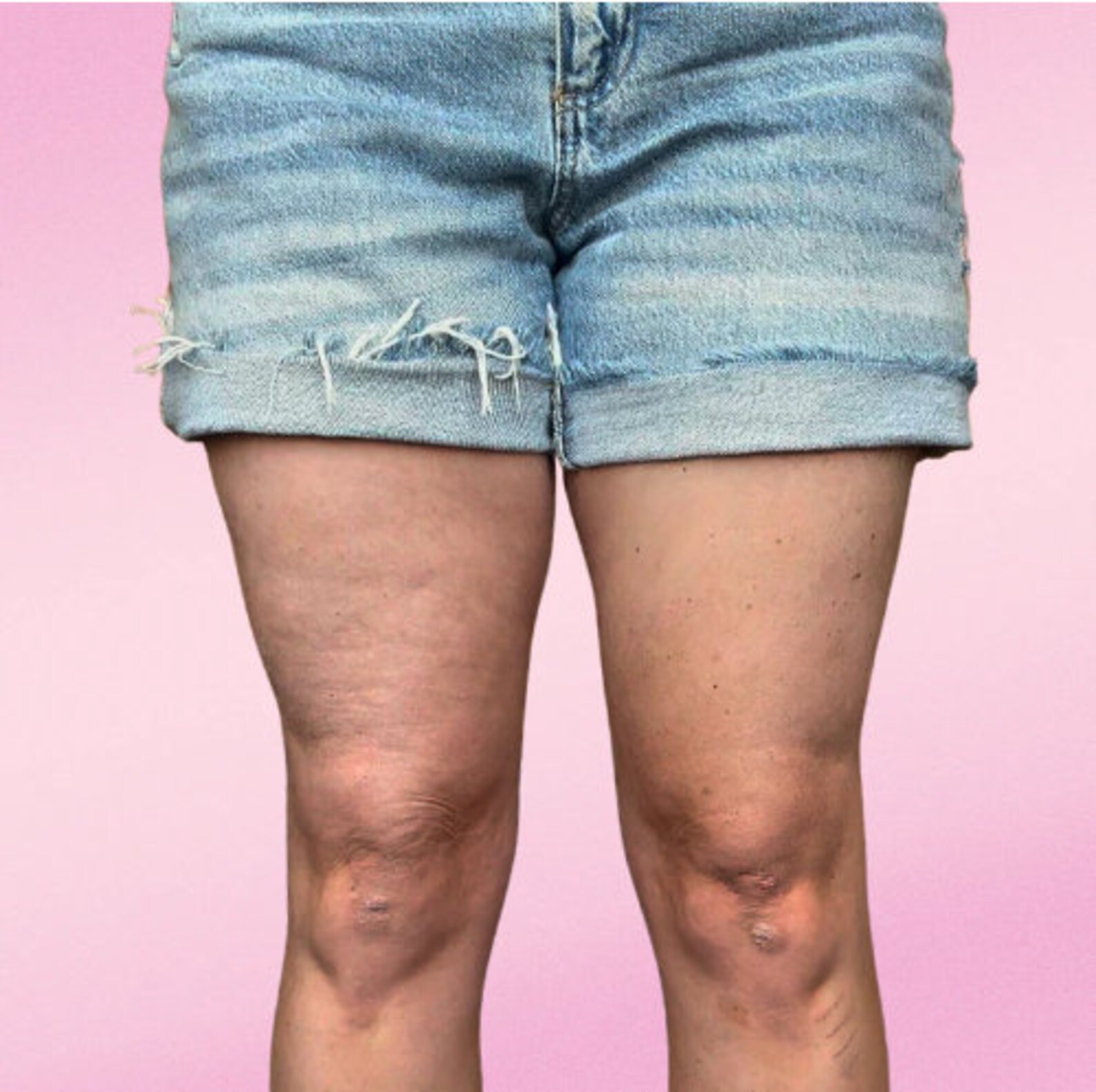 10 PACK: Tonee Skin-lifting Tape - Instant Cellulite Reduction, Skin ...
