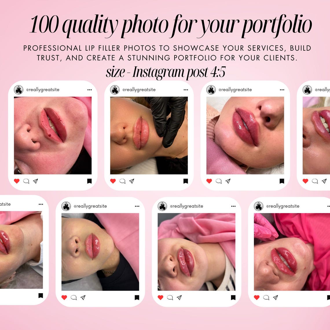 100 Lip Filler Instagram Post | Lip Injection Photo | Skincare Post ...