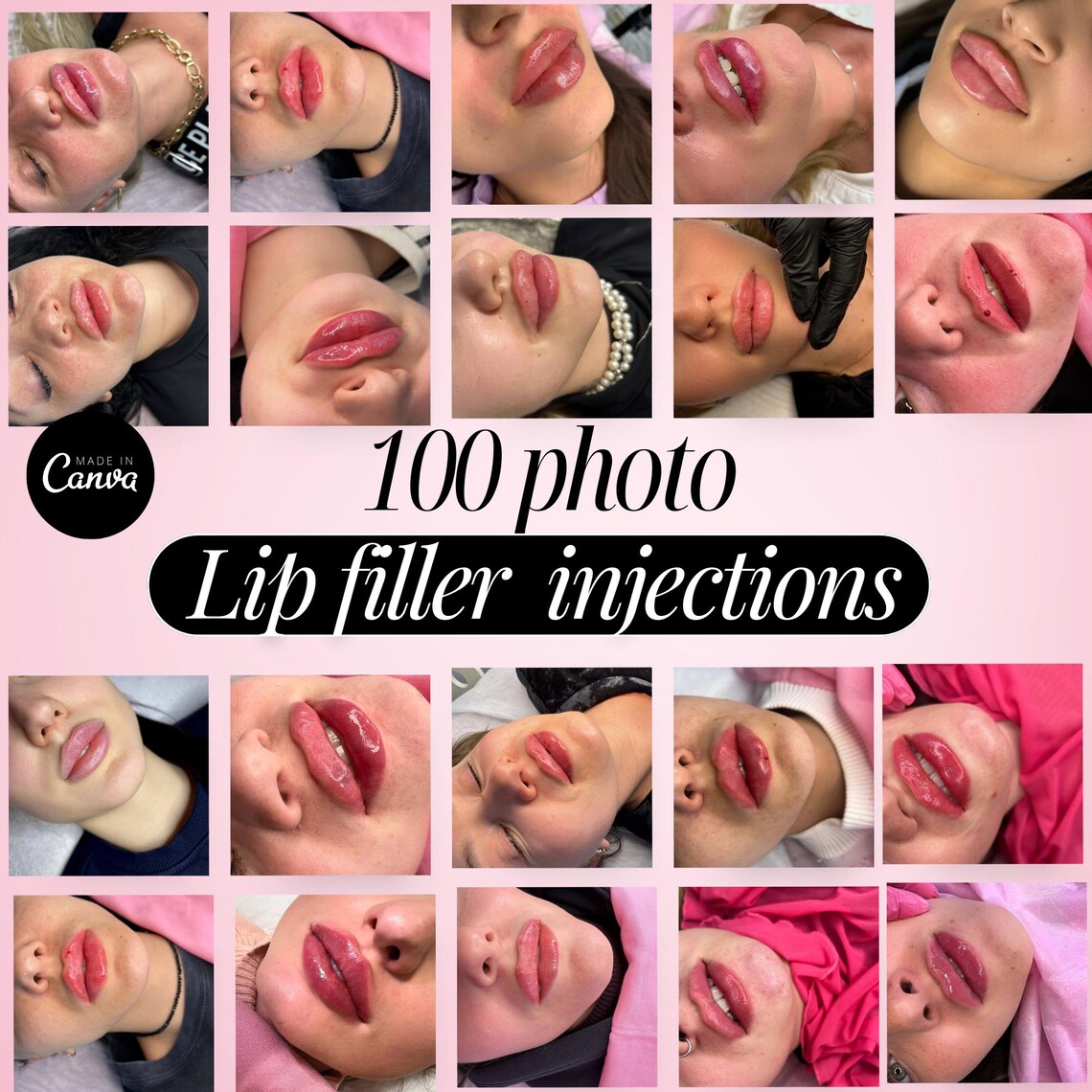 100 Lip Filler Instagram Post | Lip Injection Photo | Skincare Post | Lip Filler Canva Template ...