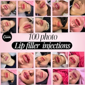 100 Lip Filler Instagram Post | Lip Injection Photo | Skincare Post ...