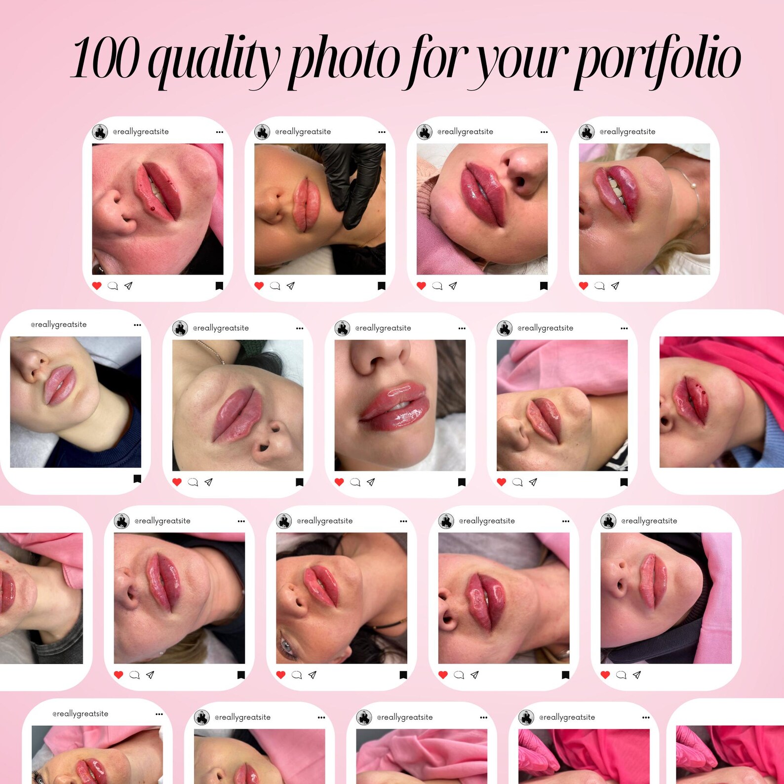 100 Lip Filler Instagram Post | Lip Injection Photo | Skincare Post | Lip Filler Canva Template ...