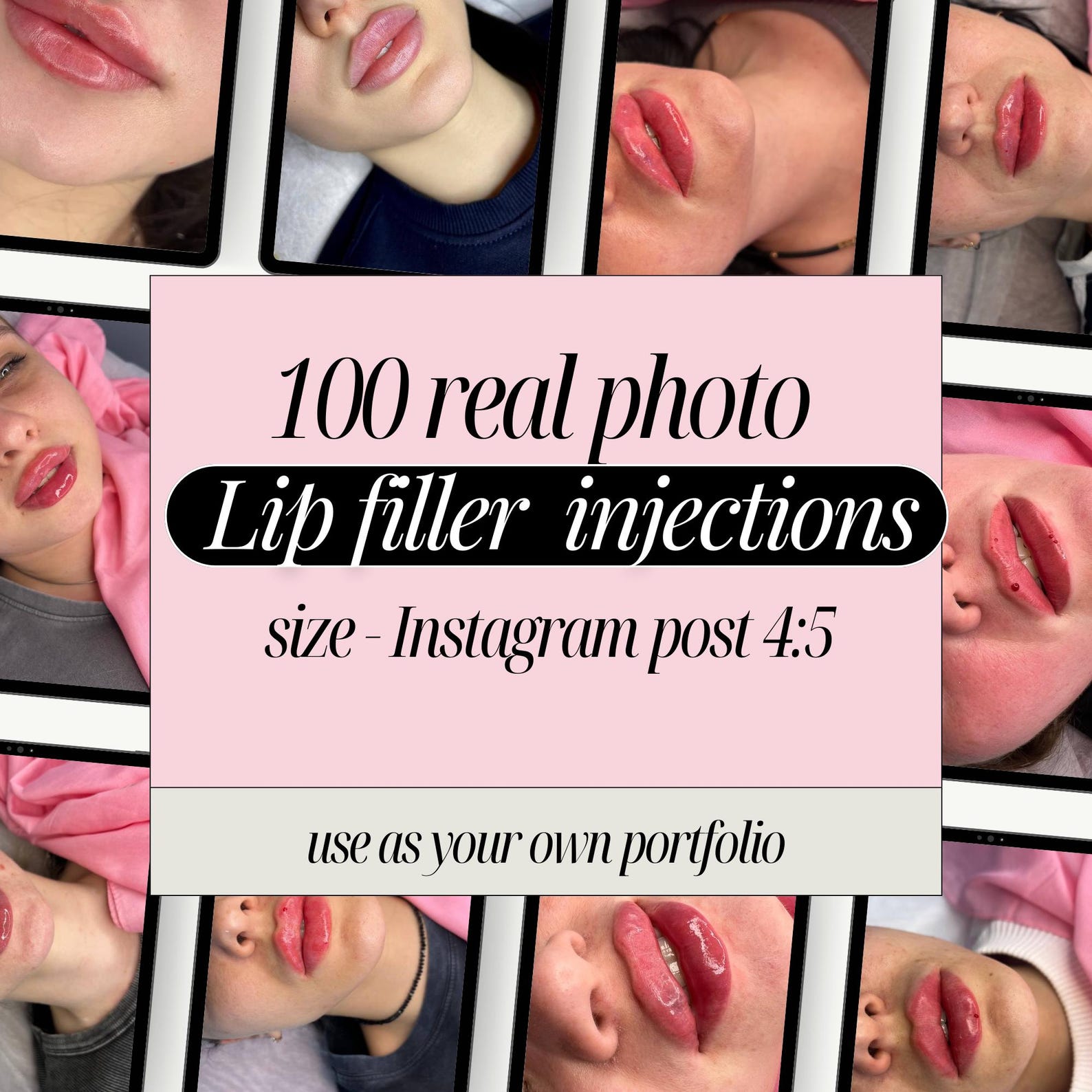 100 Lip Filler Instagram Post | Lip Injection Photo | Skincare Post | Lip Filler Canva Template ...