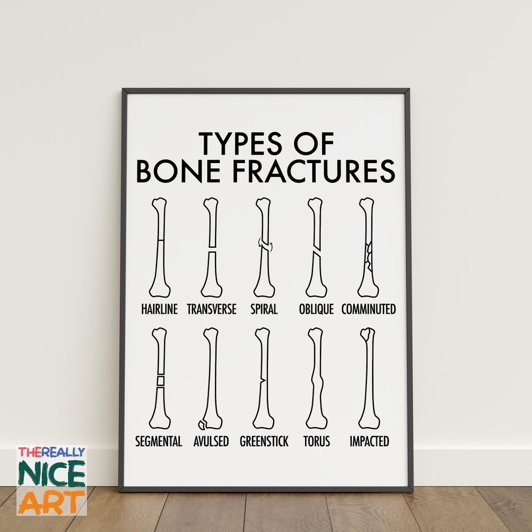 Bone Fractures PRINTABLE Wall Art, Detailed Medical Illustration ...