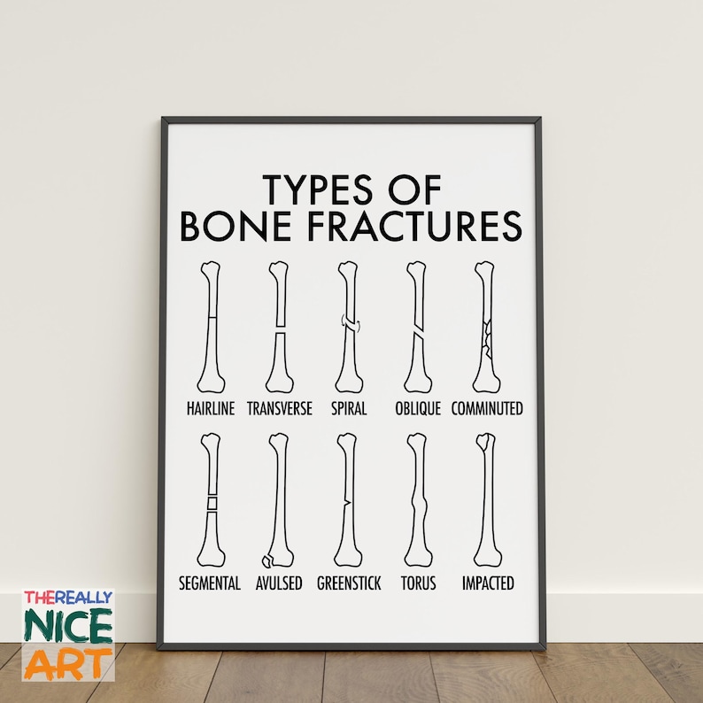 Bone Fractures PRINTABLE Wall Art, Detailed Medical Illustration ...
