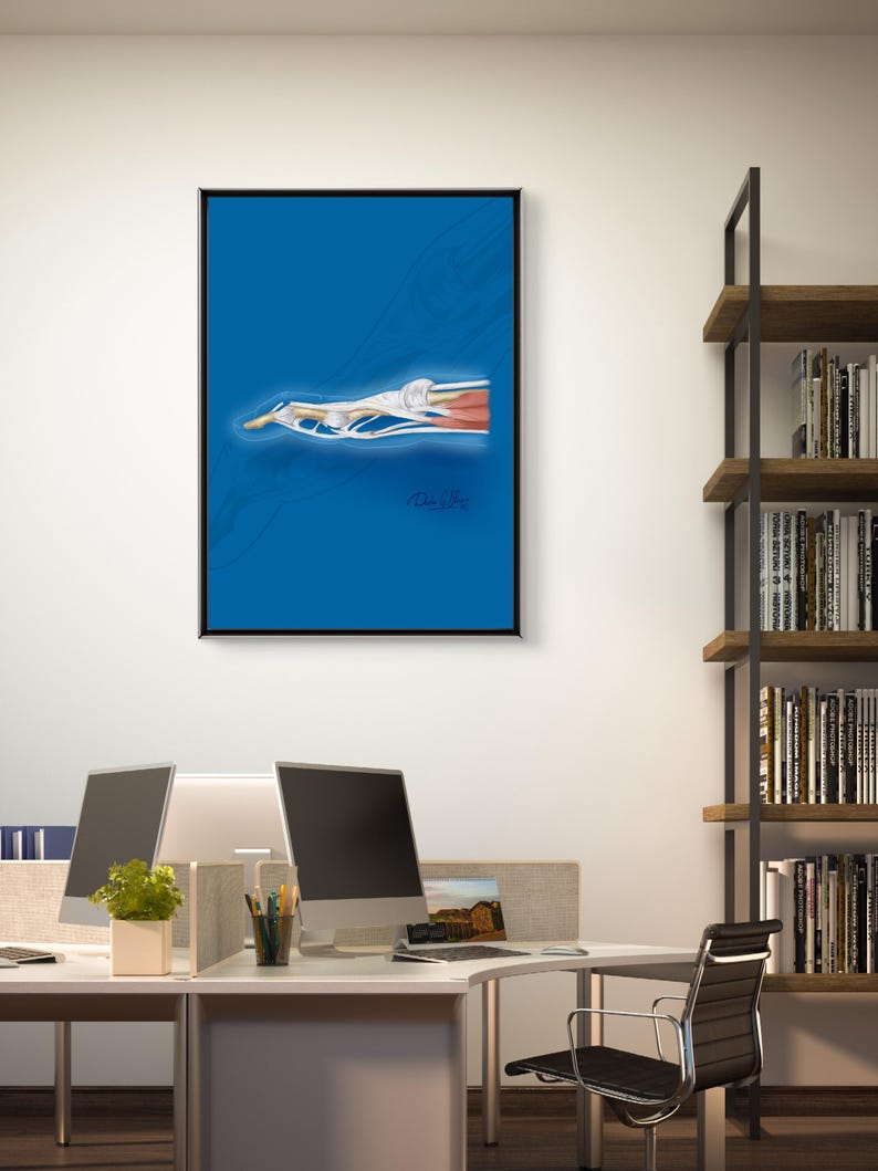 Swan Neck Finger Deformity Illustration Doctor's Office Decor Medical ...