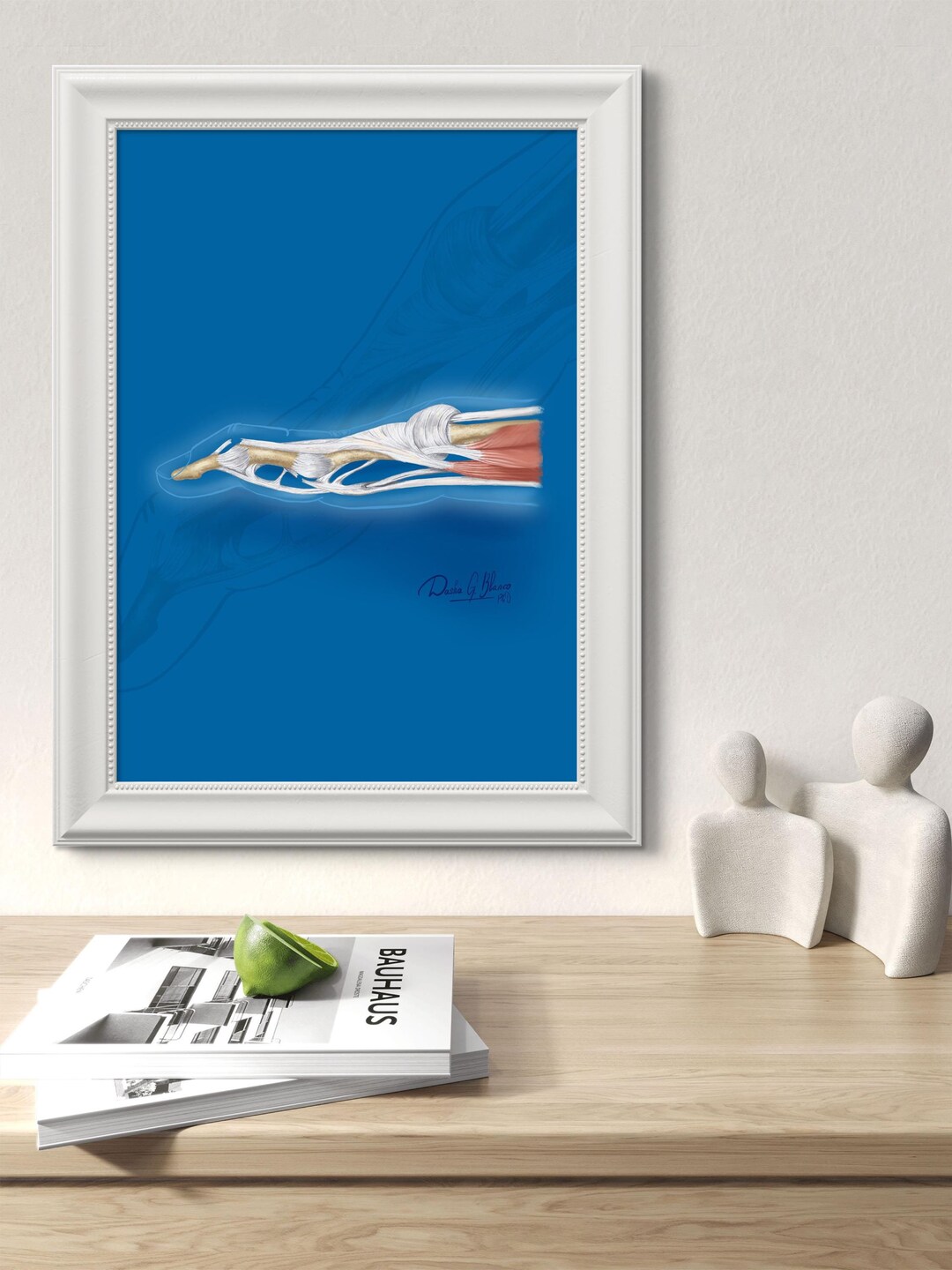 Swan Neck Finger Deformity Illustration Doctor's Office Decor Medical ...