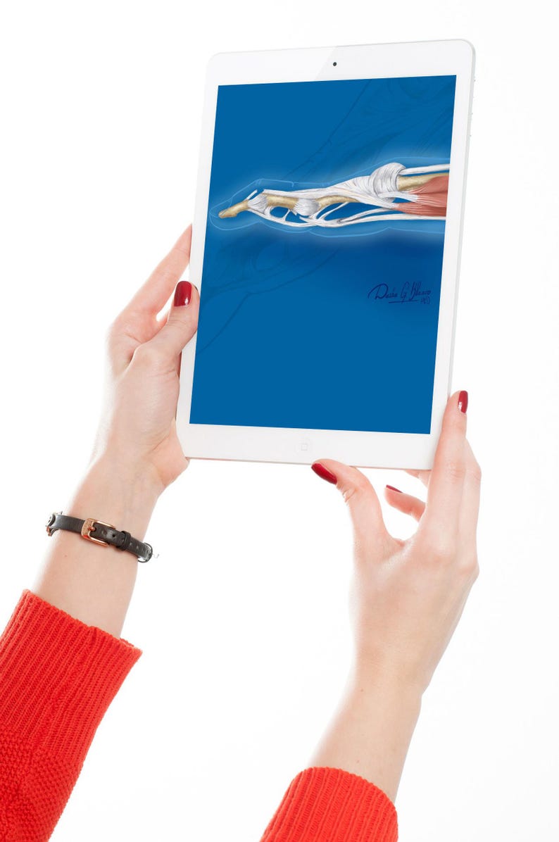 Swan Neck Finger Deformity Illustration Doctor's Office Decor Medical ...