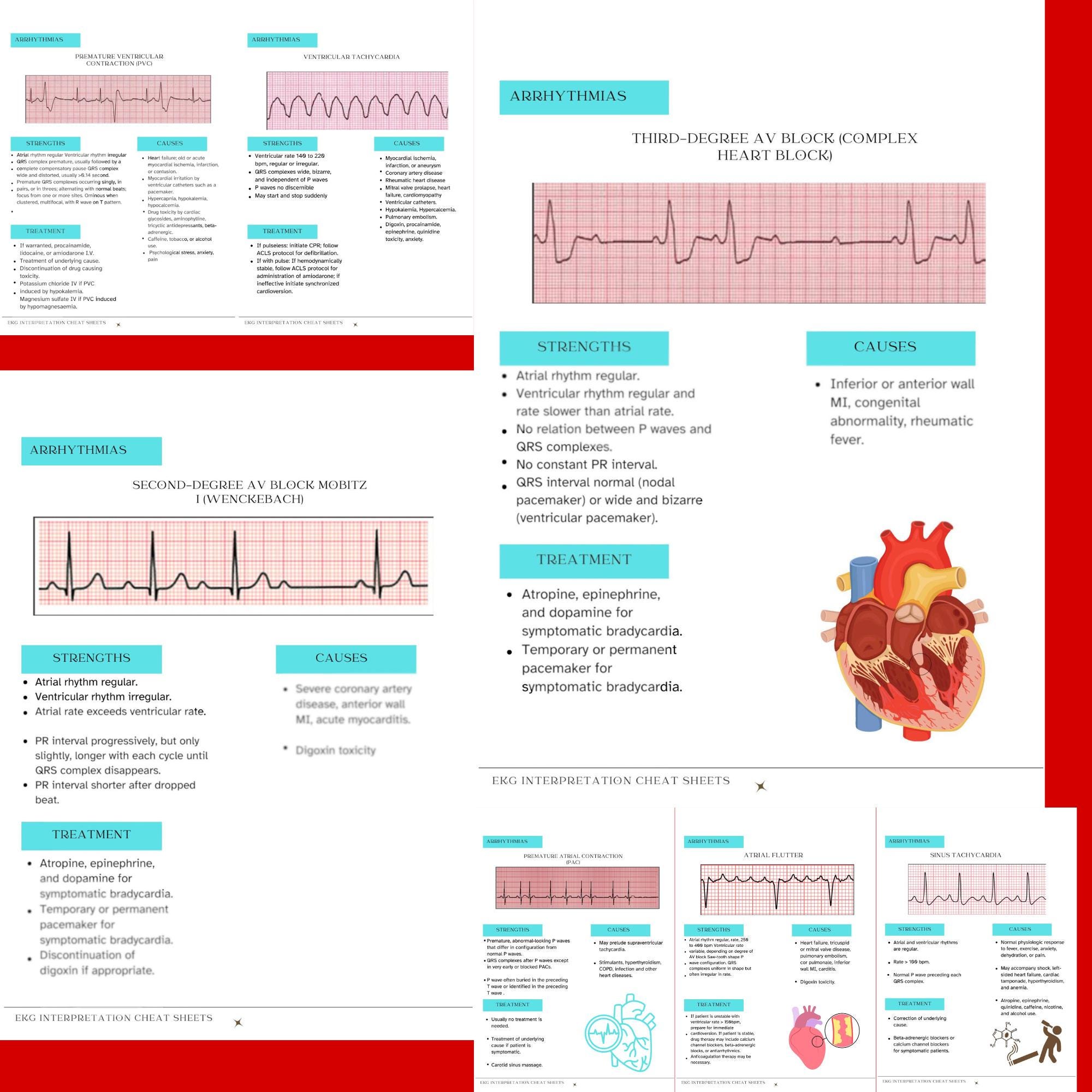 EKG Interpretation &heart Arrhythmias Study ,simplified Cheat Sheet ...