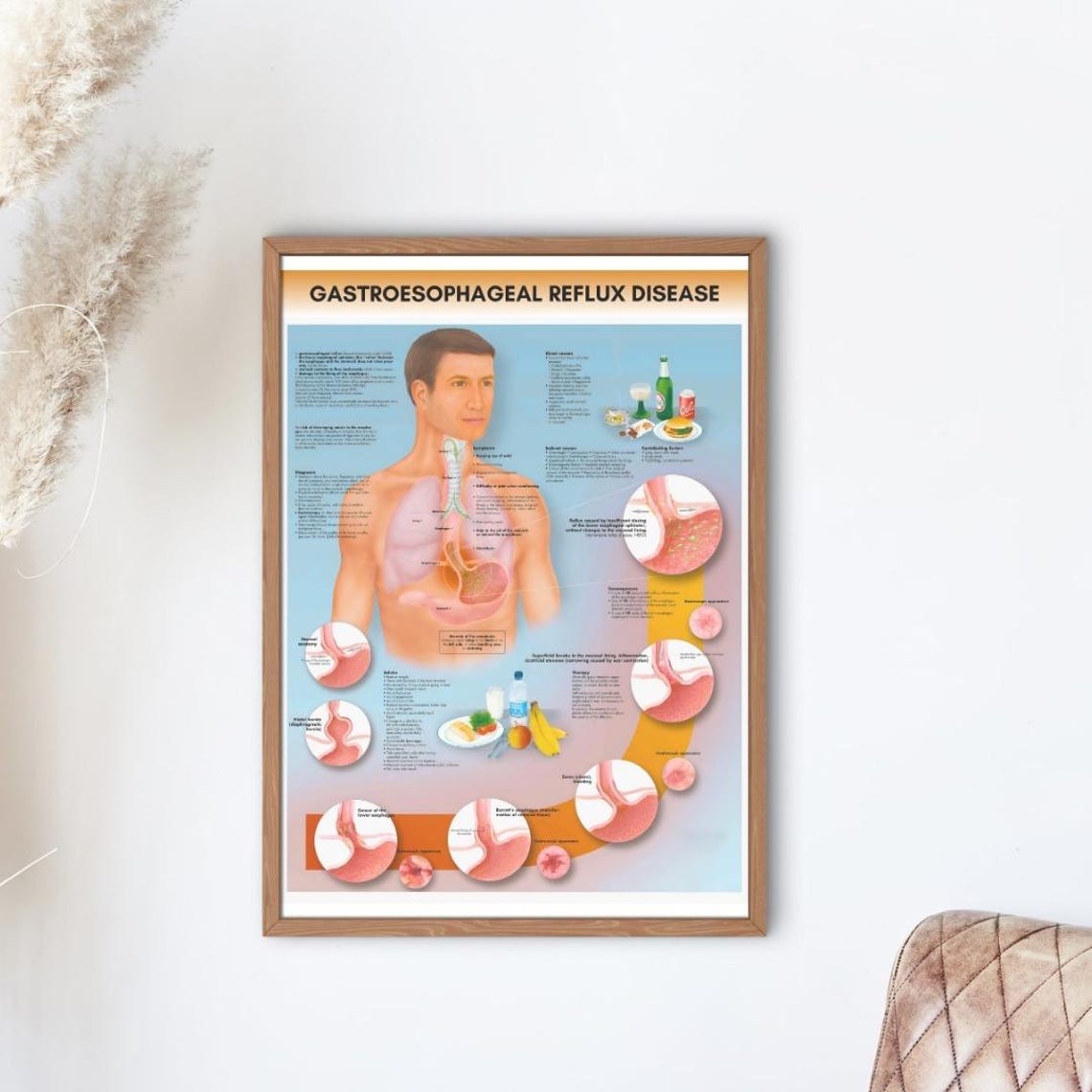 Gastroesophageal Reflux Disease Anatomy Poster (digital Download) - Etsy