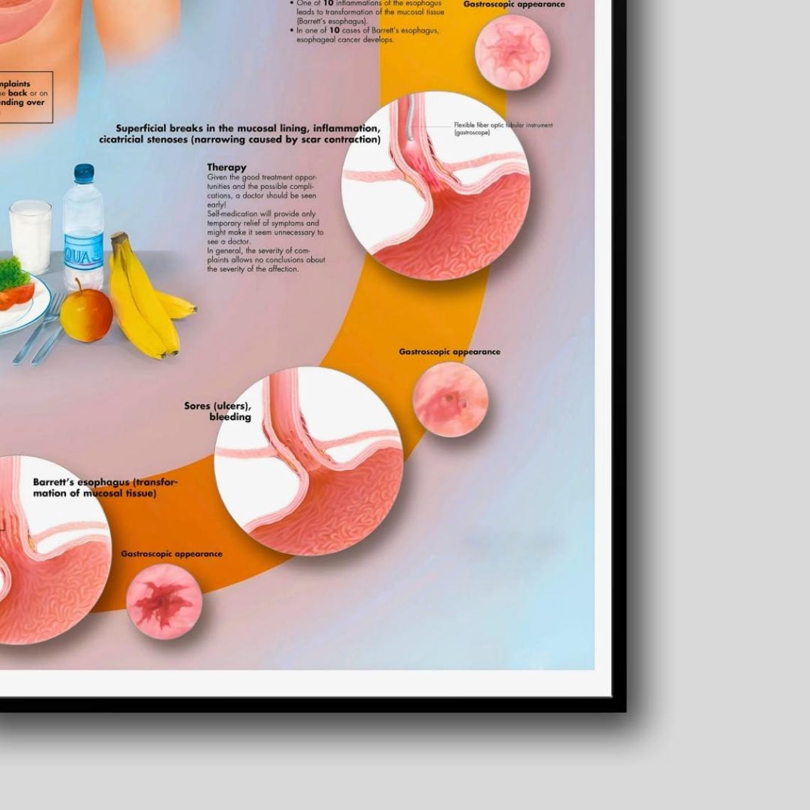 Gastroesophageal Reflux Disease Anatomy Poster (digital Download) - Etsy