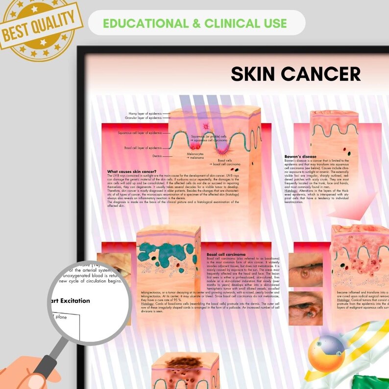 Skin Cancer Anatomy Poster, Human Biology Medical Art (digital Download ...