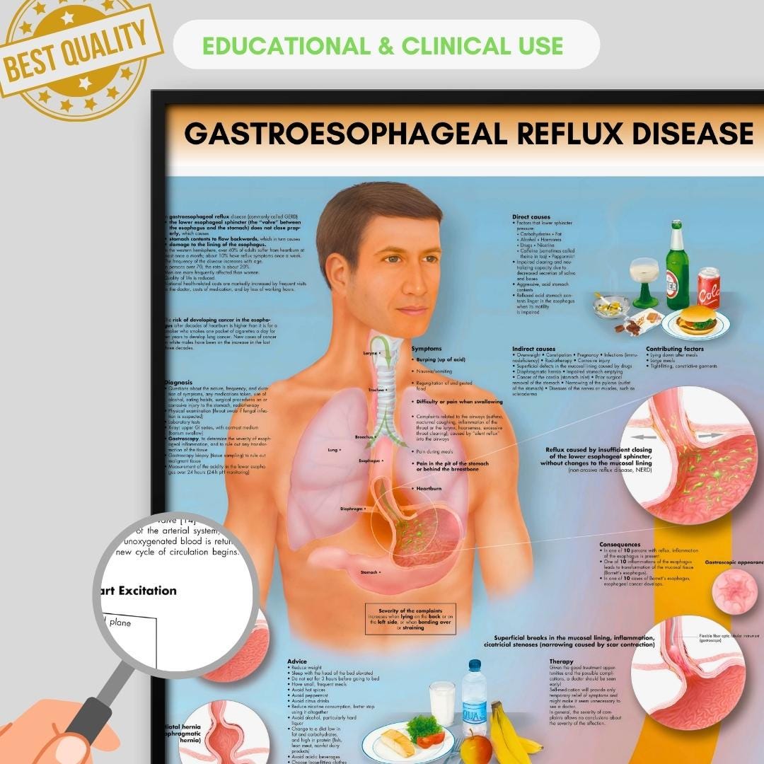 Gastroesophageal Reflux Disease Anatomy Poster (digital Download) - Etsy