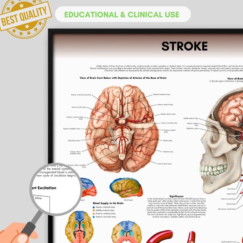 Stroke Anatomy Poster | Human Biology, Medical Student (digital ...