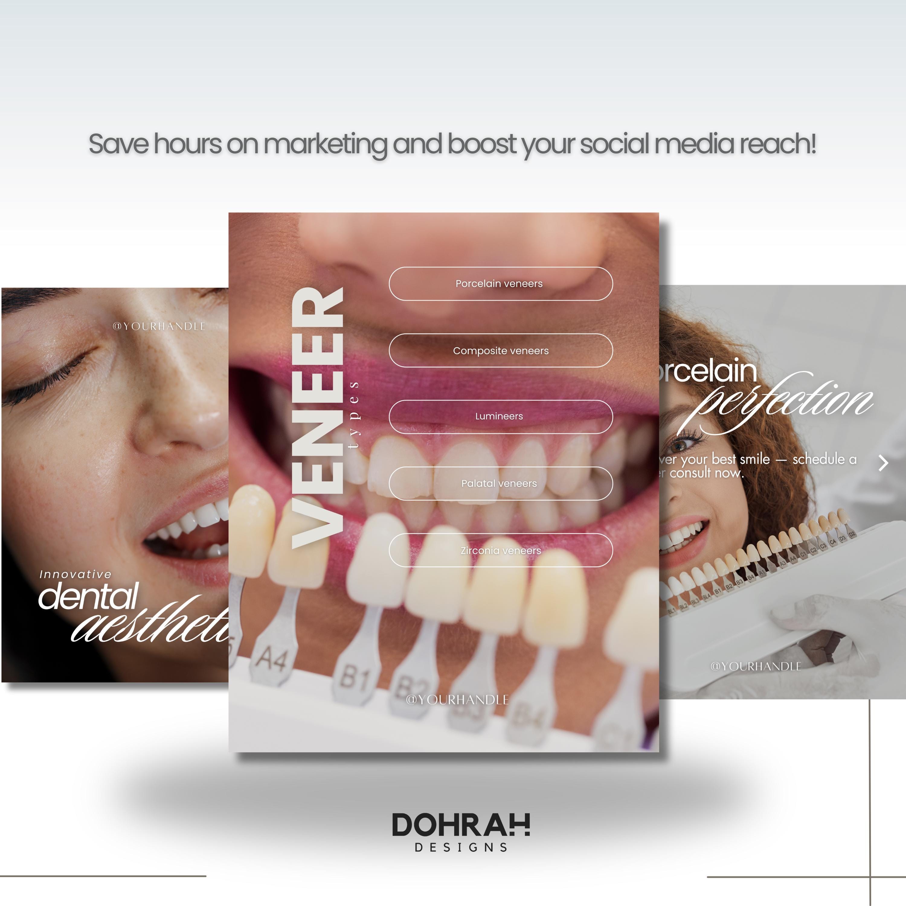 Veneer Instagram Posts: Dental Practice Social Media Templates (canva ...