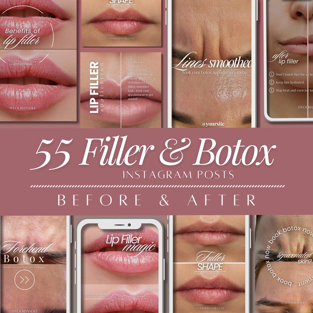 Lip Filler and Botox Before & After Posts: Nurse Injector Instagram ...