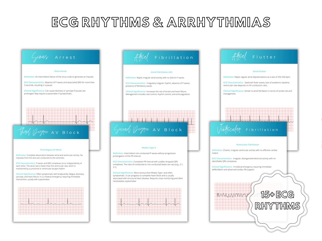 ECG Rhythms & Arrhythmias | EKG Dysarrhythmias | Sinus Rhythms | AV ...