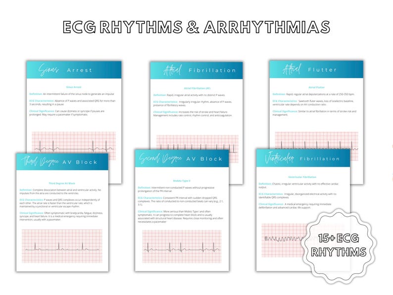 ECG Rhythms & Arrhythmias | EKG Dysarrhythmias | Sinus Rhythms | AV ...