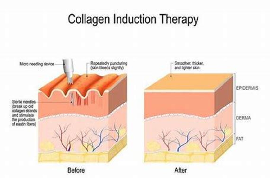 Collagen Induction Therapy - Micro Needling Training Manual - Etsy