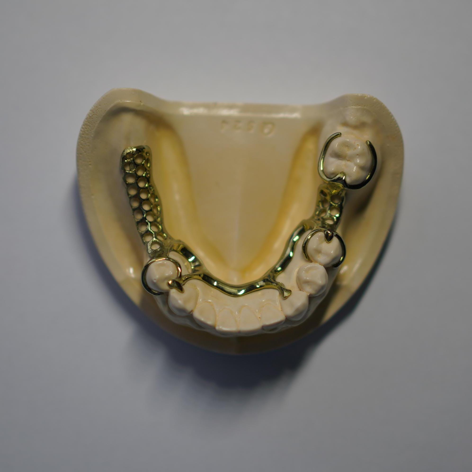 Removable Bracket and Porcelain Bridge (can Be Customized) Model for ...