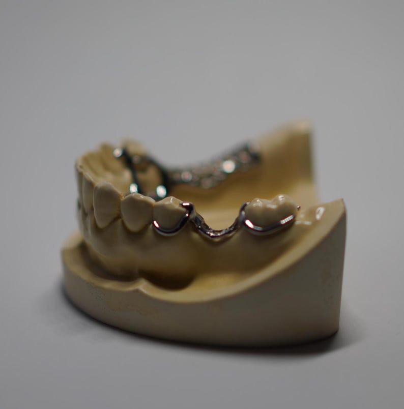 Removable Bracket and Porcelain Bridge (can Be Customized) Model for ...