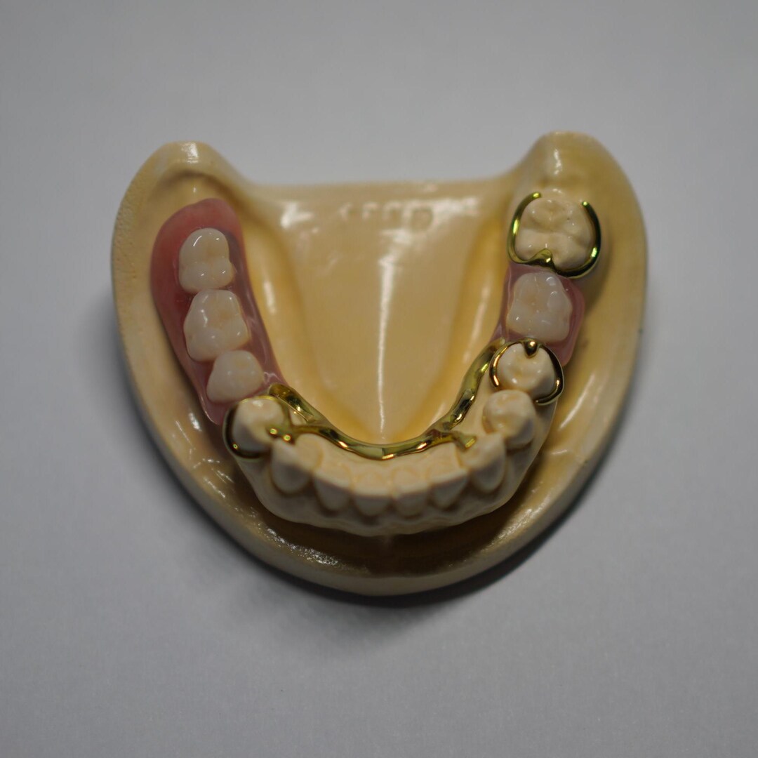 Removable Bracket and Porcelain Bridge (can Be Customized) Model for ...
