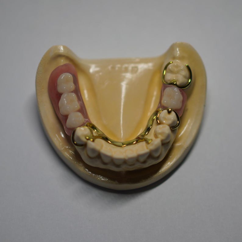 Removable Bracket and Porcelain Bridge (can Be Customized) Model for ...
