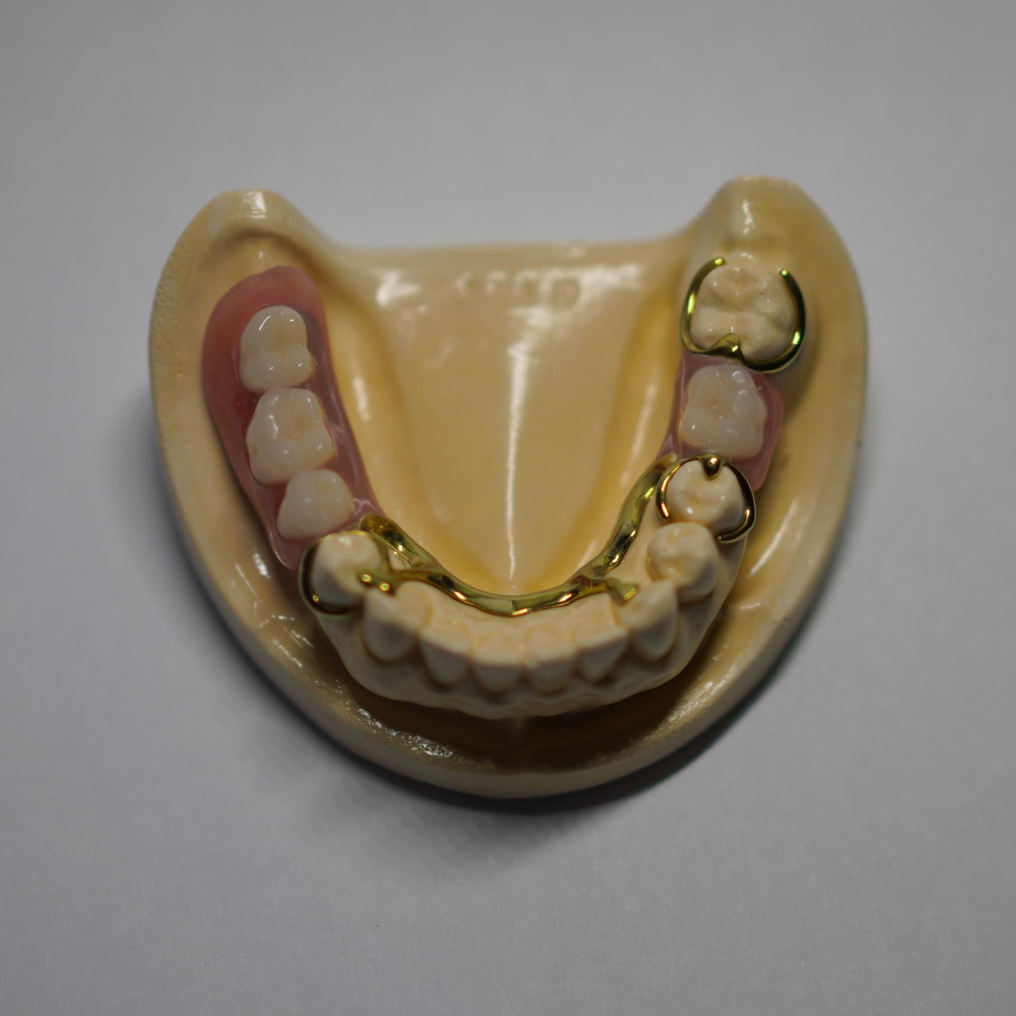Removable Bracket and Porcelain Bridge (can Be Customized) Model for ...