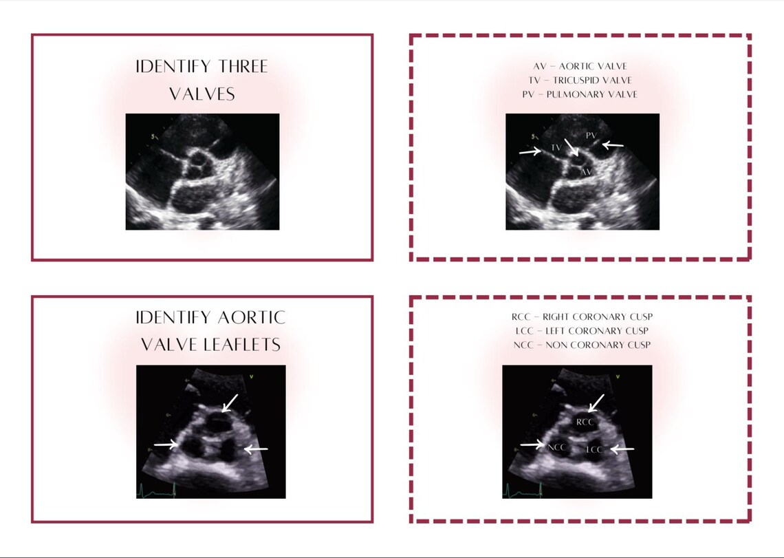 Echo Anatomy Flashcards, Real Life Protocol Views (digital File) - Etsy