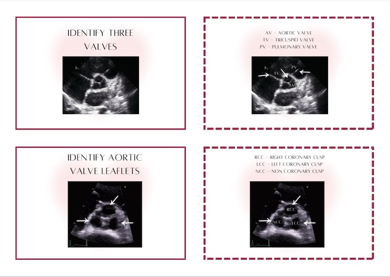 Echo Anatomy Flashcards, Real Life Protocol Views (digital File) - Etsy