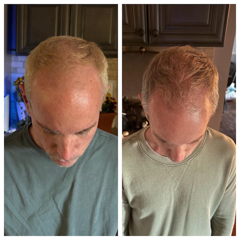 Samson's Apothecary Concentrated 1% Deoxyribose (2ddr) Hair Regrowth ...