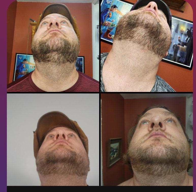 Samson's Apothecary Concentrated 1% Deoxyribose (2ddr) Hair Regrowth ...