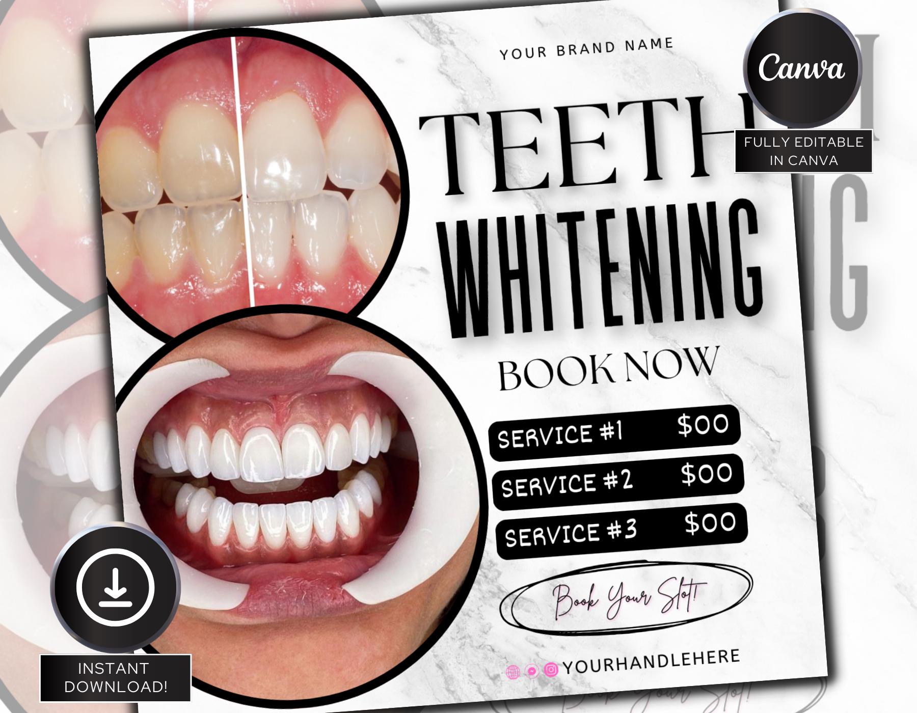 Teeth Whitening Flyer, Teeth Whitening Post, Teeth Whitening Marketing ...