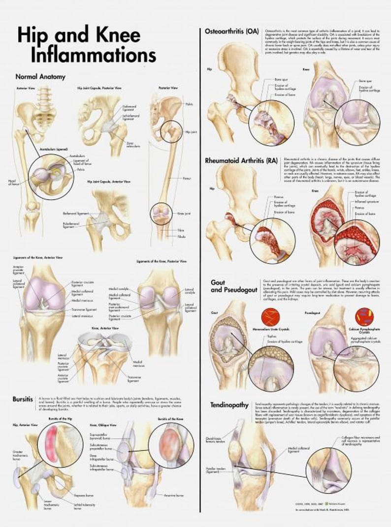 Hip and Knee Inflammations System Wall Chart Poster Print Anatomical ...