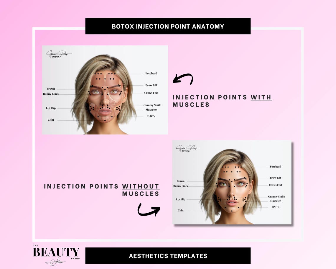 Botox Injection Points, Botox Injectors, Facial Anatomy, Art ...