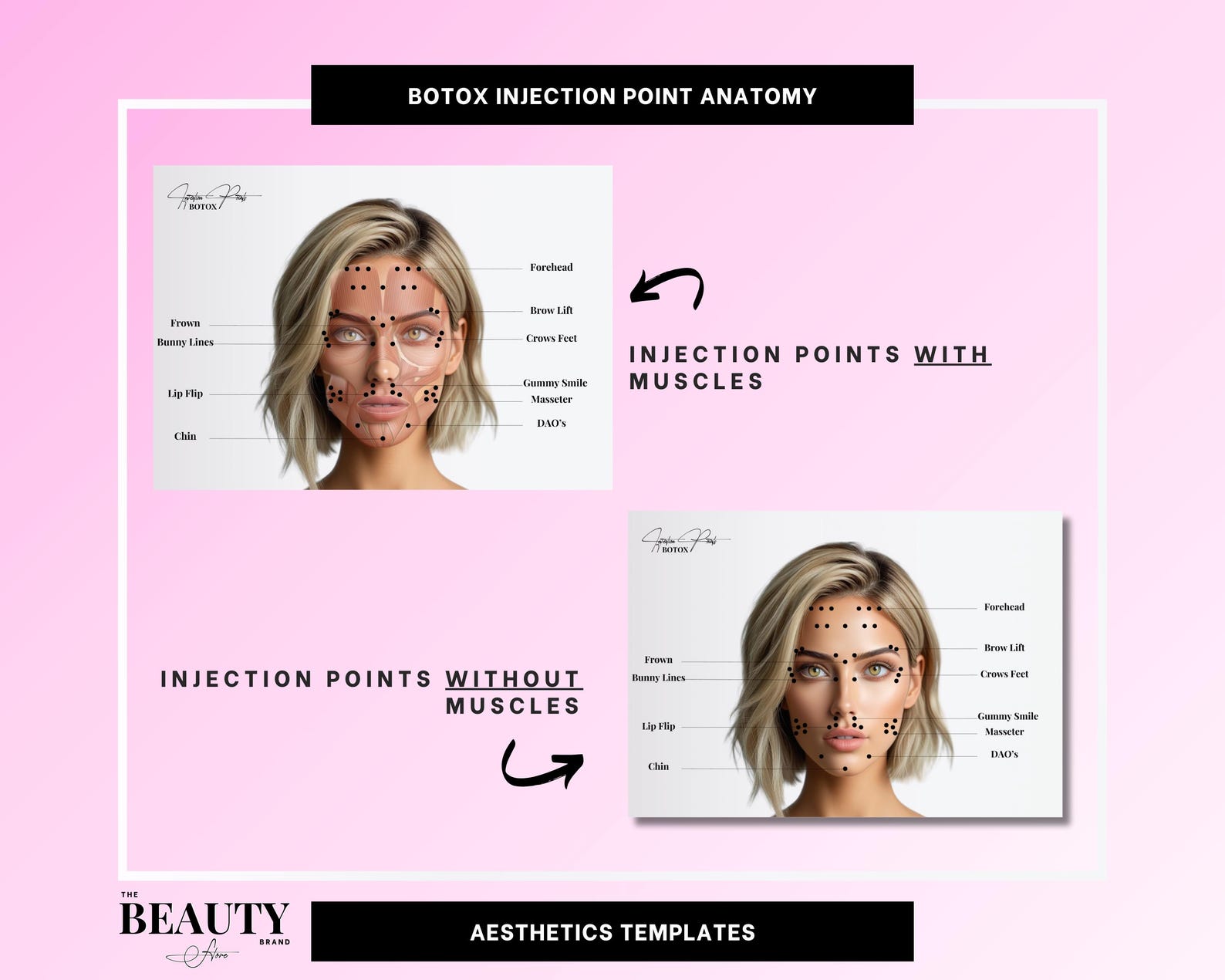 Botox Injection Points, Botox Injectors, Facial Anatomy, Art ...